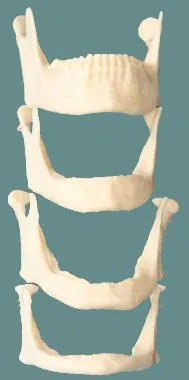 Jaw Bone Deterioration Atlanta | Facial Collapse Conyers, Snellville