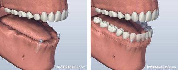 Implant Overdenture Athens | Permanent Dentures Conyers, Snellville GA